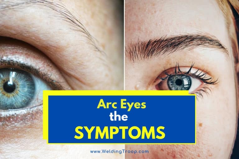 What is Arc Eye? (Welder Flash + Symptoms?)